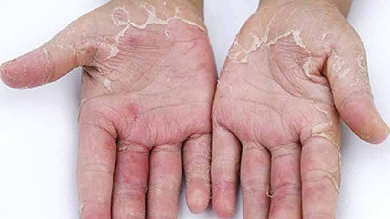 Skin Peeling: అరచేతులు.. అరికాళ్ళ చర్మం పొట్టులుగా ఎందుకు రాలుతుంది ...