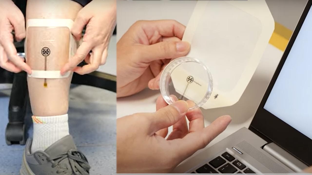 Smart Bandage: ఈ స్మార్ట్ బ్యాండేజ్ శరీరంలో గాయాల పరిస్థితిని ...