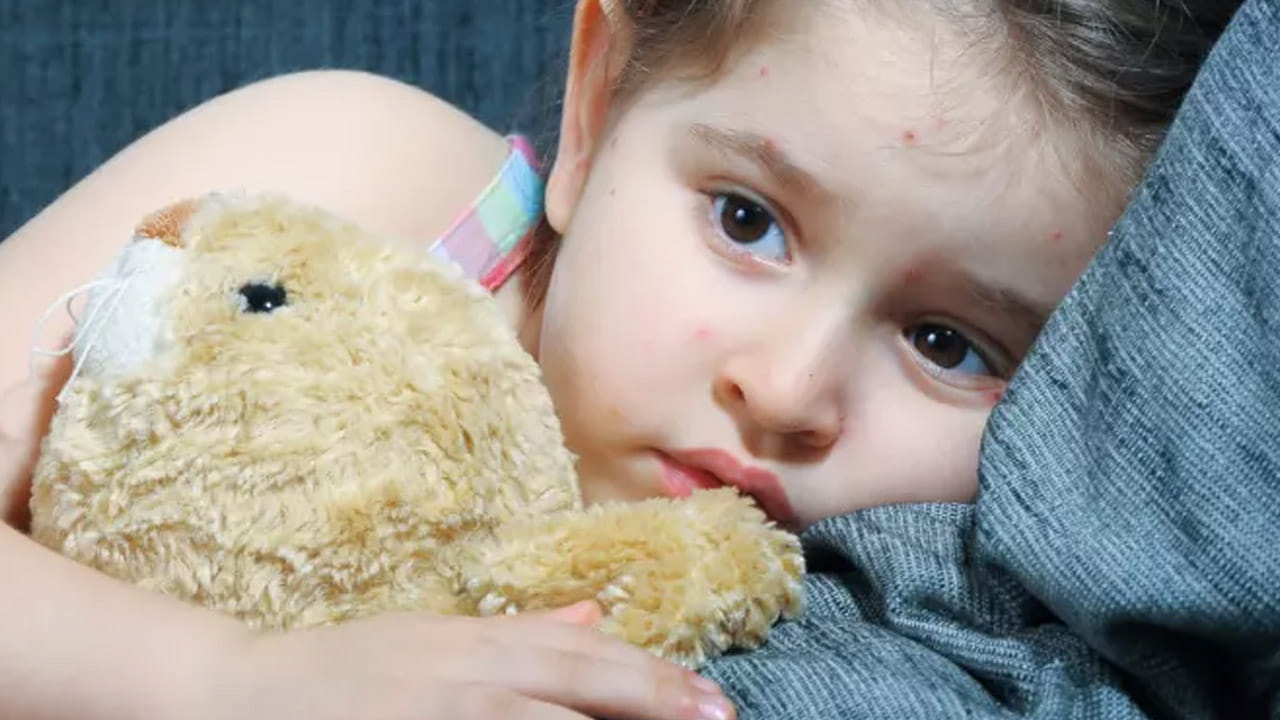 Chickenpox: ఈ లక్షణాలు శరీరంలో కనిపించడం ప్రారంభిస్తే.. చికెన్ పాక్స్ ...