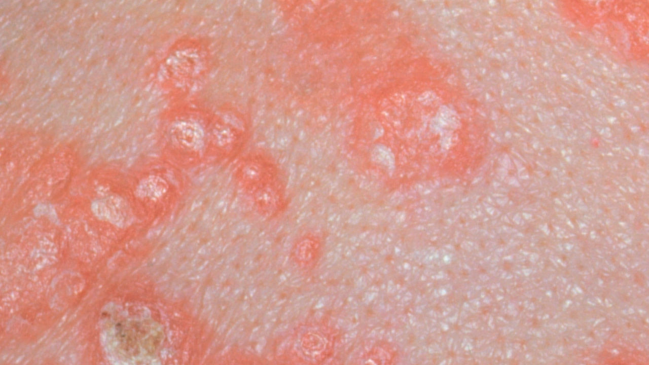Psoriasis: ఆందోళన కలిగిస్తున్న సొరియాసిస్.. పెను సవాల్ గా మారుతున్న ...