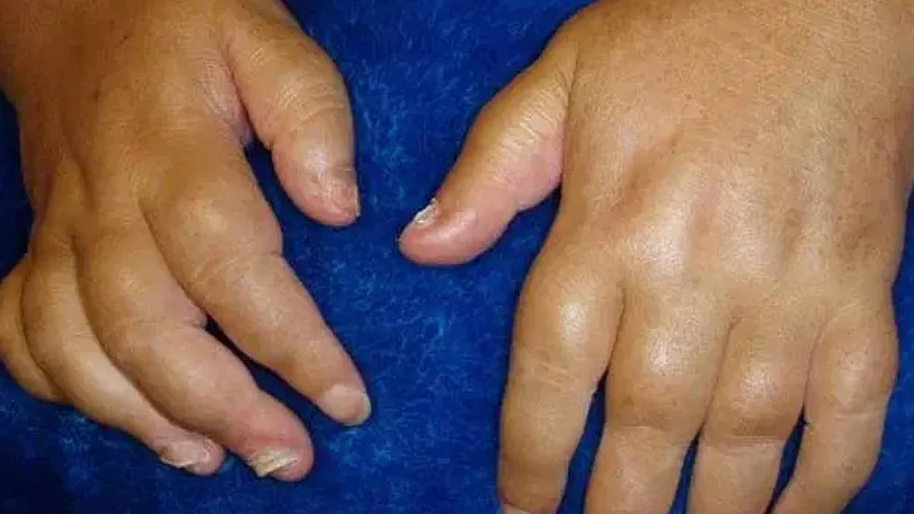 Swollen Hands: ఉదయం నిద్ర లేవగానే చేతులు వాచిపోయాయా? మీకు ఈ సమస్యలు ...