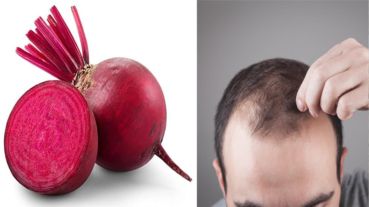 Lifestyle: బట్టతల సమస్యతో ఇబ్బంది పడుతున్నారా.? బీట్‌రూట్‌ ప్యాక్‌తో ...