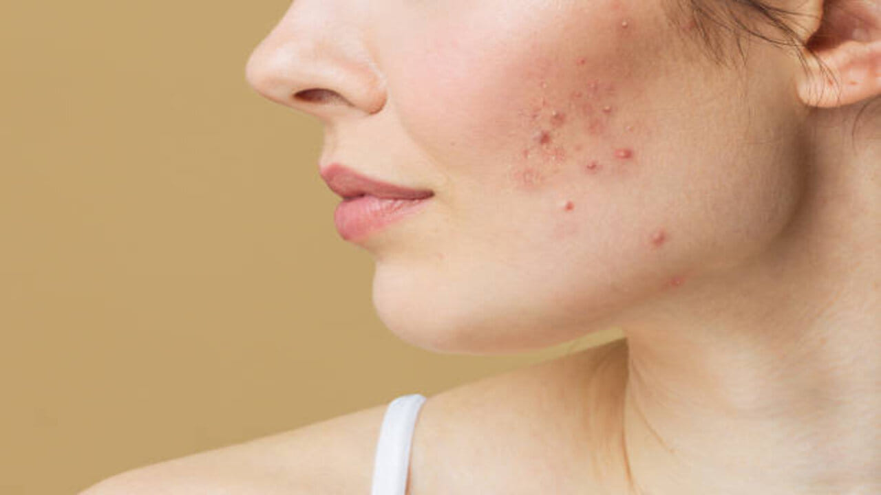 Pimples Problem: ఒక్క రూపాయి ఖర్చు లేకుండా మీ మొఖంపై మొటిమల సమస్యకు ...