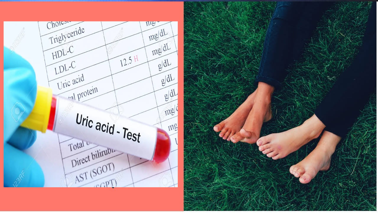 Uric Acid Test: శరీరంలో తయారైన యూరిక్ యాసిడ్ కిడ్నీని దెబ్బతీస్తుందా ...
