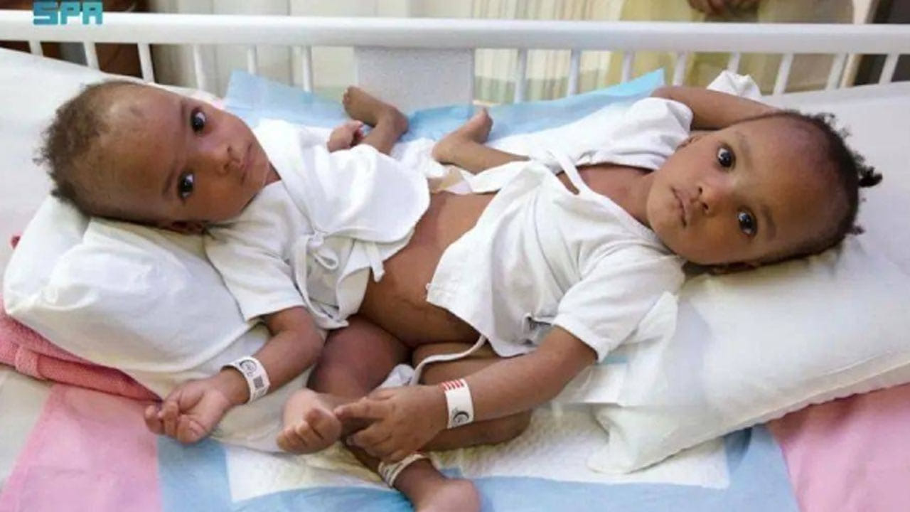 Conjoined Twins: ఏడాది వయసు అవిభక్త కవలలకు అరుదైన చికిత్స.. 14 గంటల ...