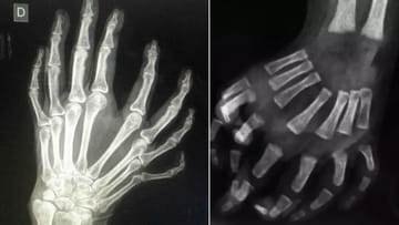 Viral: చేతికి 8 వేళ్లు.. ఎక్స్‌రే చూసిన డాక్టర్లకు దిమ్మతిరిగే షాక్ ...