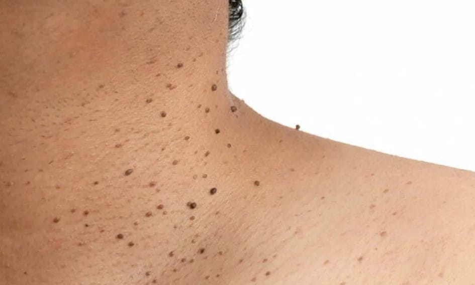 Pulipiri Removal Tips: పులిపిర్లతో చిరాకు వస్తుందా.. వాటికి ఇలా చెక్ ...