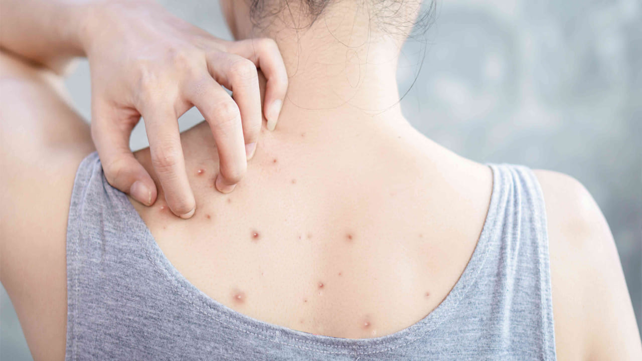 Back acne: ఈ మొటిమలతో వెన్ను చూపించలేక పోతున్నారా.? ఈ సింపుల్ టిప్స్ ...