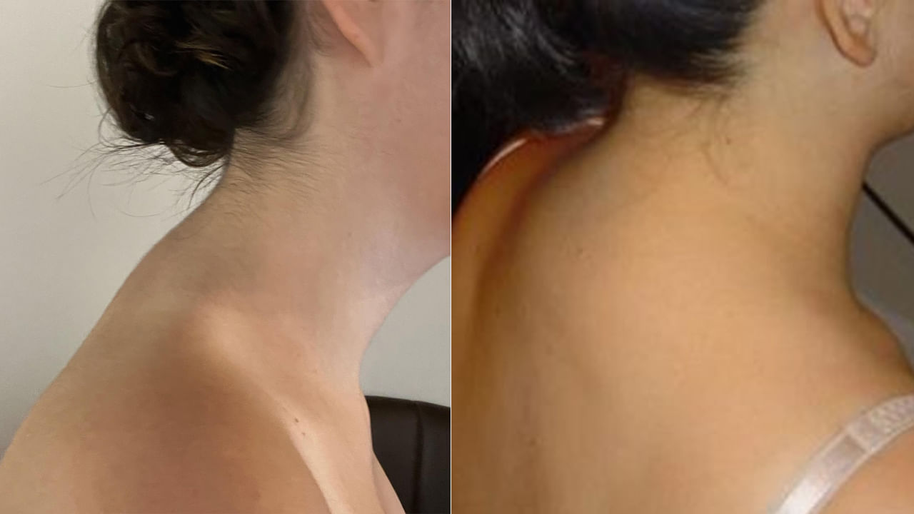 Yoga for Neck Hump: మెడ మూపురంతో ఇబ్బంది పడుతున్నారా.. ఈ యోగాసనాలు ట్రై ... Yoga for Neck Hump: మెడ మూపురంతో ఇబ్బంది పడుతున్నారా.. ఈ యోగాసనాలు ట్రై ...