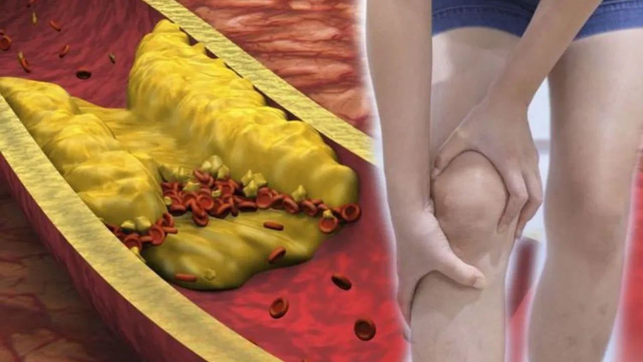 Cholesterol Health: ఈ లక్షణాలు కనిపిస్తే శరీరంలో చెడు కొలెస్ట్రాల్‌కి ...
