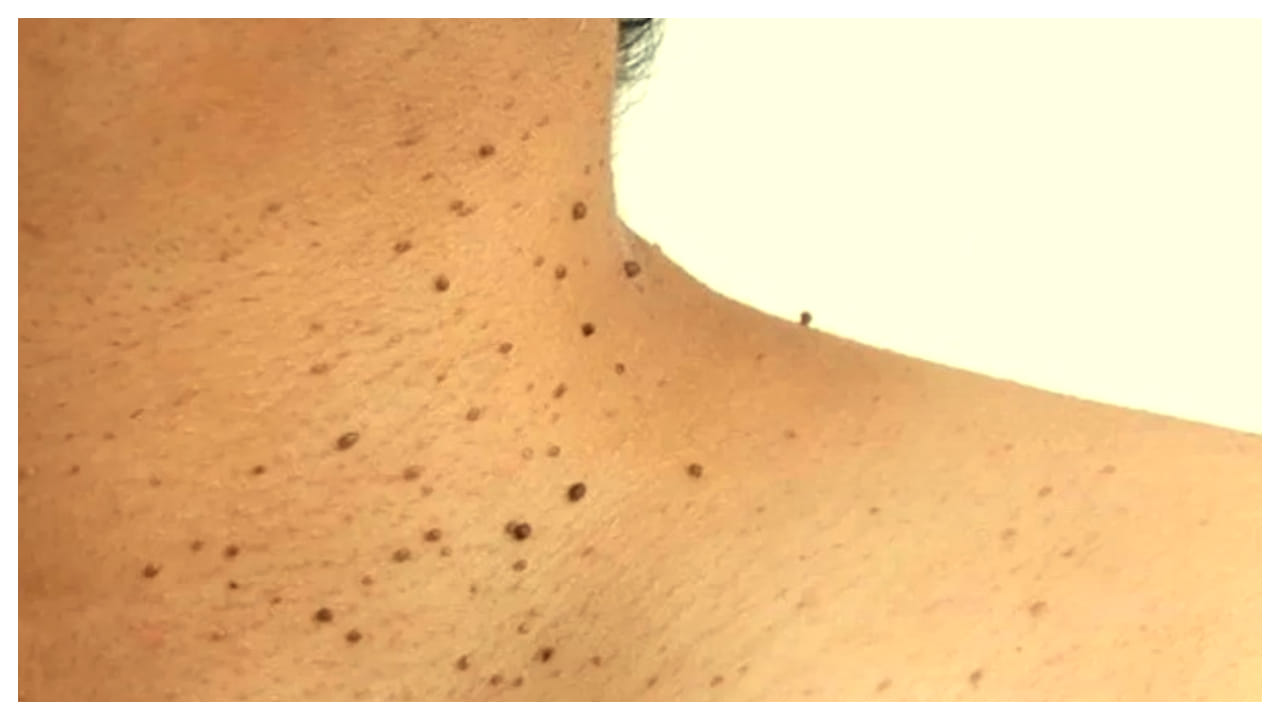 Warts Relief Tips: పులిపిర్లను తగ్గించే ఎఫెక్టీవ్ చిట్కాలు ఇవే.. పైసా ...