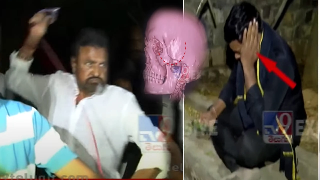 Mohan Babu: టీవీ9 రిపోర్టర్ రంజిత్‌కు ముగిసిన సర్జరీ.. డాక్టర్లు ...