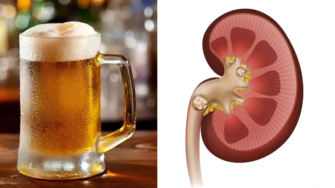 kidney stones Vs Beer: బీరు తాగితే.. నిజంగానే కిడ్నీలో రాళ్లు ...